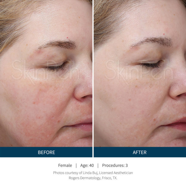 Before and After | SkinPen | Bellus Medical