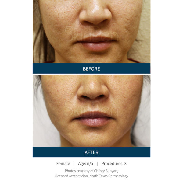 Before and After | SkinPen | Bellus Medical