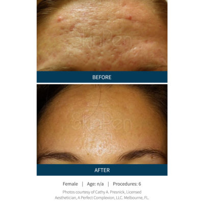 Before and After | SkinPen | Bellus Medical
