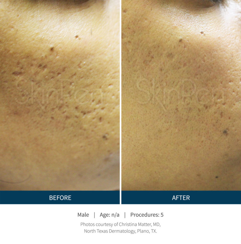 Before and After | SkinPen | Bellus Medical