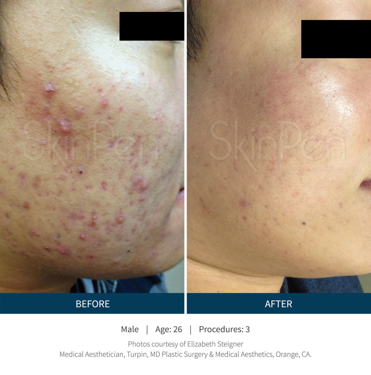 Before and After | SkinPen | Bellus Medical