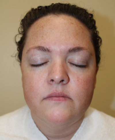 Get Started | SkinPen | Bellus Medical